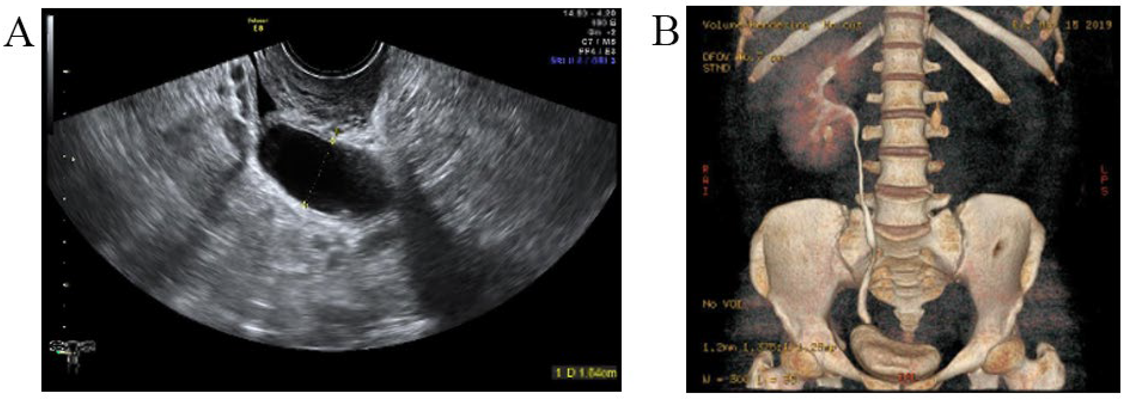 Gynecological Diagnosis and Treatment of Ectopic Ureter Insertion into ...