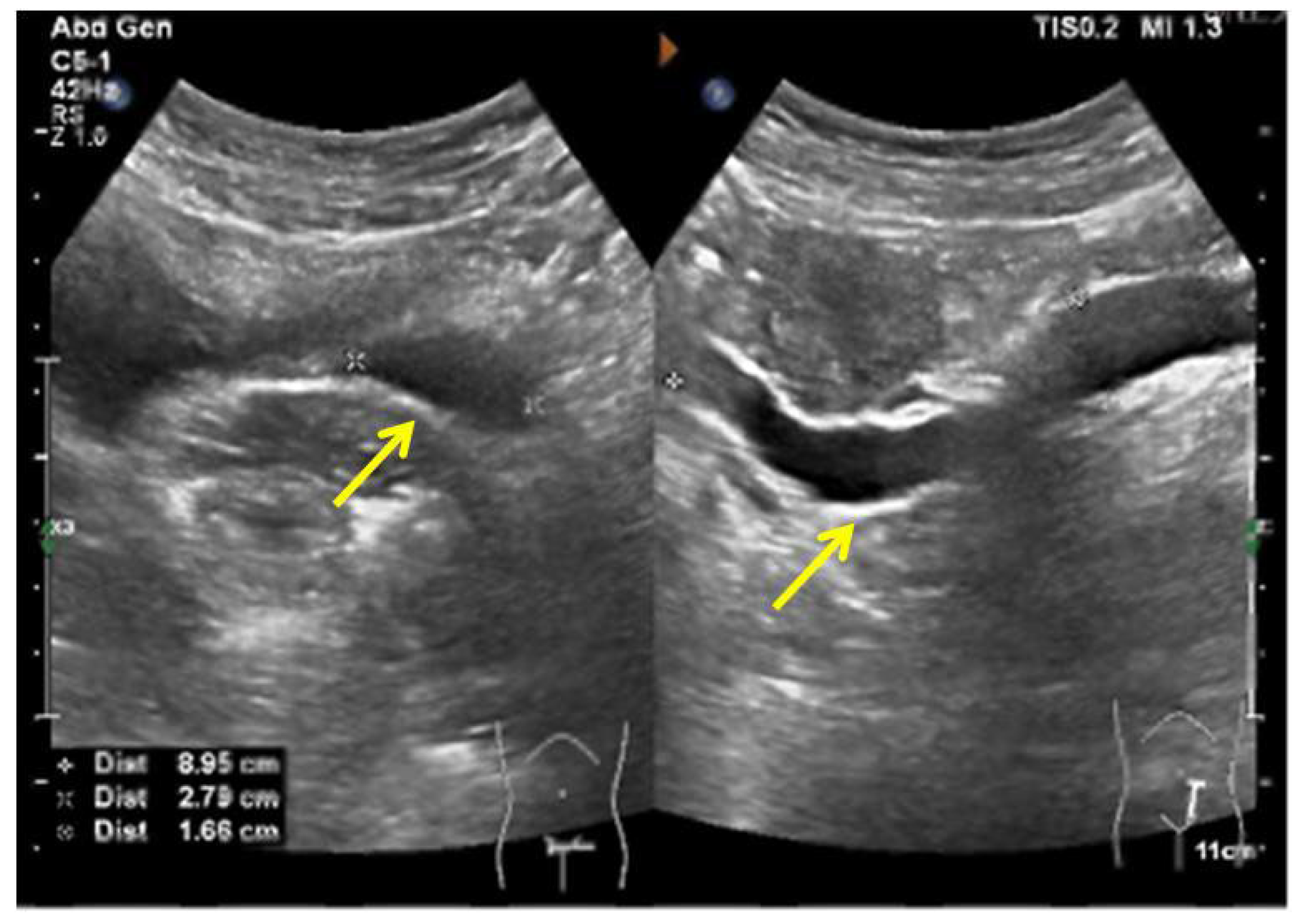 Gynecological Diagnosis and Treatment of Ectopic Ureter Insertion into Vagina: Analysis of Five ...