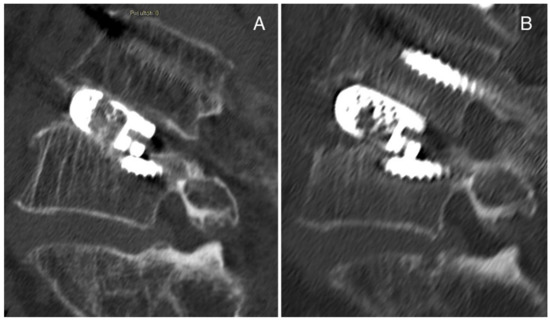 Complications in Spinal Fusion Surgery: A Systematic Review of ...