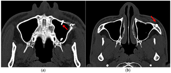 JCM | Free Full-Text | Risk Factors for Maxillary Sinus Pathology after ...