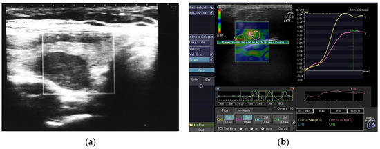 Elastographic Evaluation of Thyroid Nodules in Children and Adolescents ...