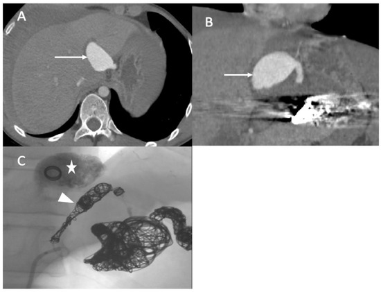 Endovascular Management of Vascular Complications in Ehlers–Danlos ...