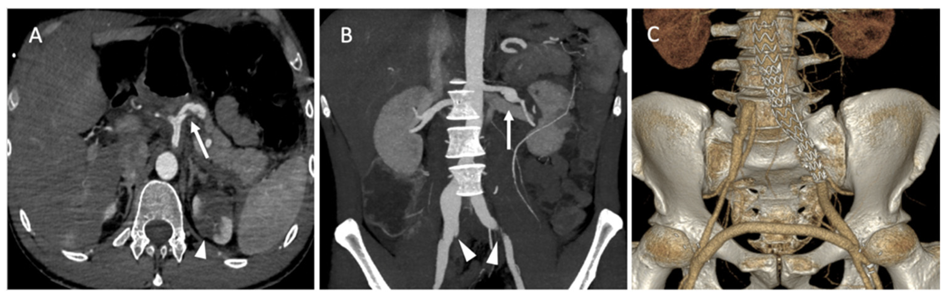 Endovascular Management of Vascular Complications in Ehlers–Danlos ...