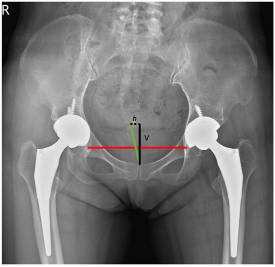 Degree of Pelvic Rotation in the Coronal Plane on Postoperative ...