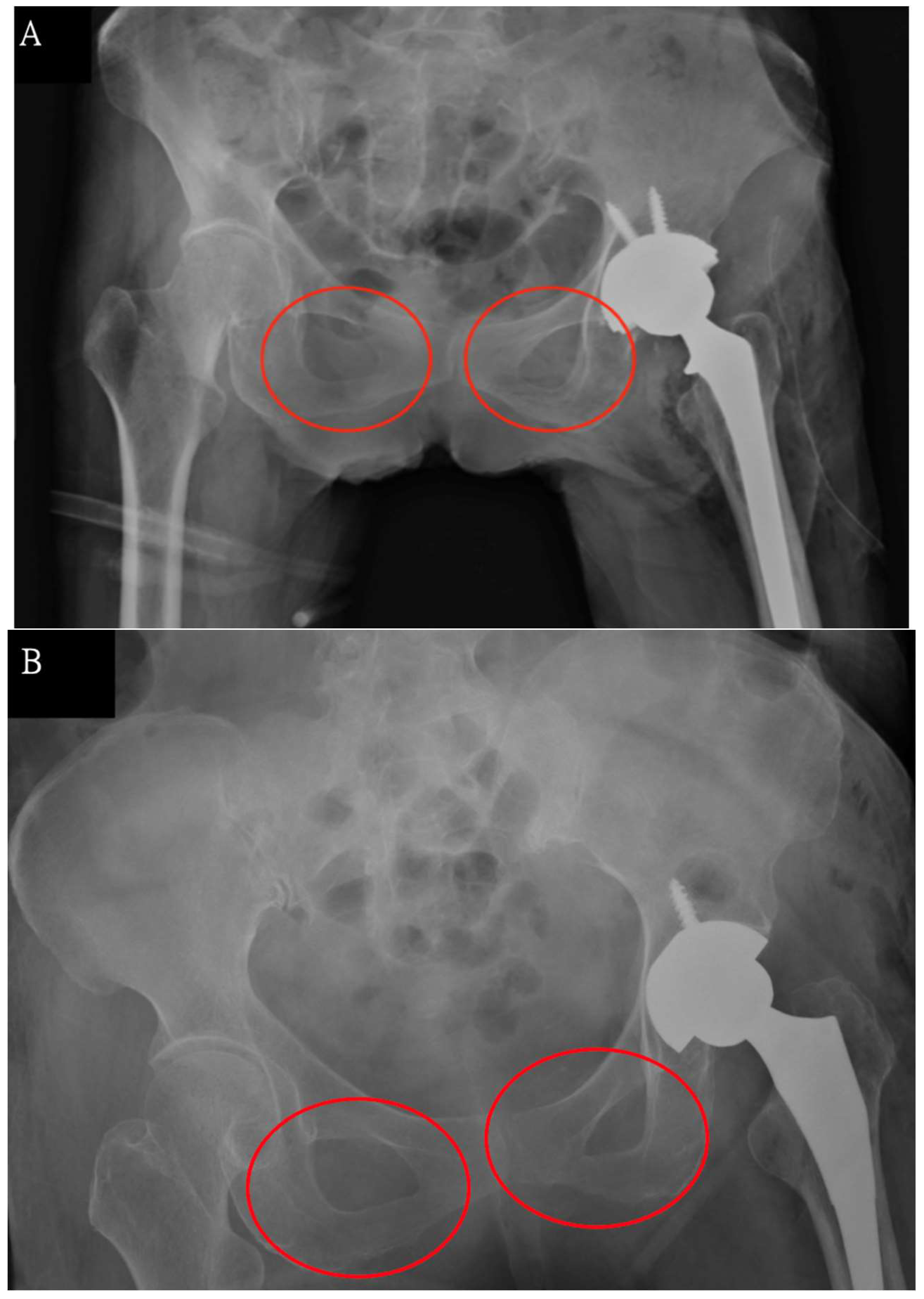 Degree of Pelvic Rotation in the Coronal Plane on Postoperative Radiographs Obtained after Total ...