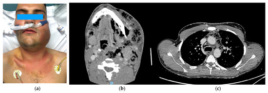 Risk Factors Associated with Post-Operative Complications in Multidisciplinary Treatment of ...
