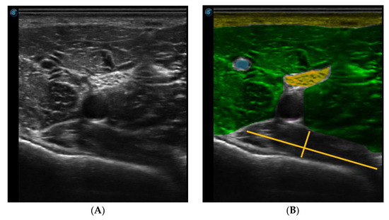 Dry Needling of the Popliteus Muscle Validation by Ultrasound Imaging ...