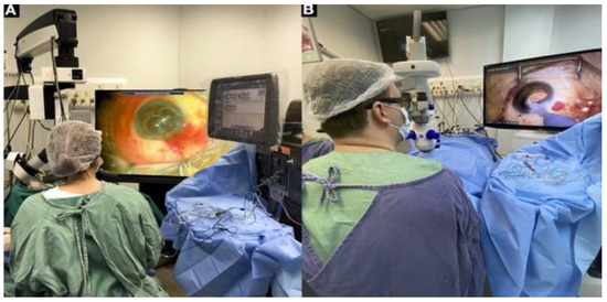 Advances in Vitreoretinal Surgery