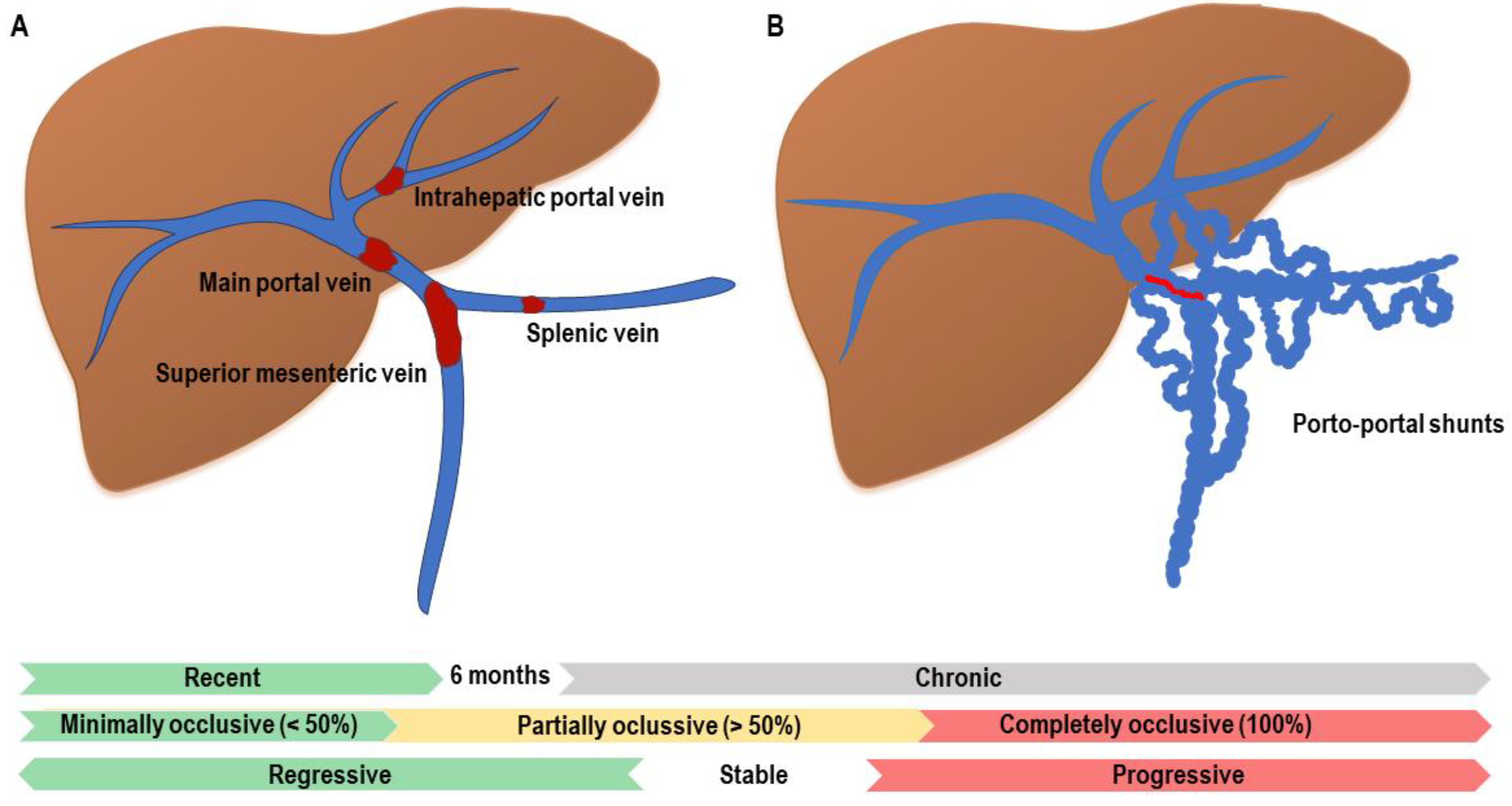 Jcm Free Full Text Portal Vein Thrombosis In The Setting Of