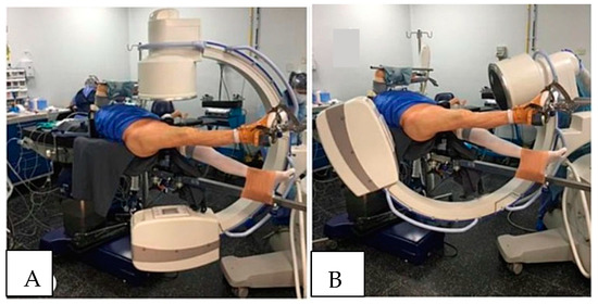 Well Leg Compartment Syndrome: Pathophysiology, Prevention, and Treatment