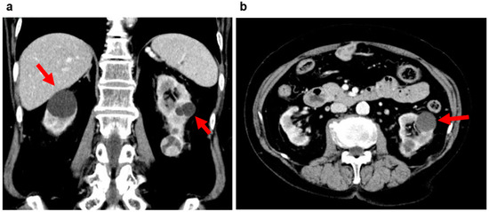 Cystic Kidney Diseases That Require a Differential Diagnosis from ...