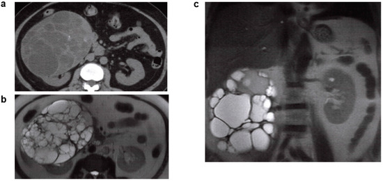 Cystic Kidney Diseases That Require a Differential Diagnosis from ...