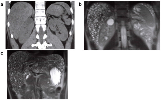 Cystic Kidney Diseases That Require a Differential Diagnosis from ...