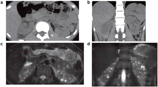Cystic Kidney Diseases That Require a Differential Diagnosis from ...