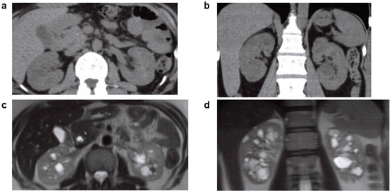 Cystic Kidney Diseases That Require a Differential Diagnosis from ...