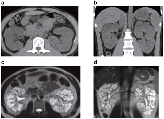 Cystic Kidney Diseases That Require a Differential Diagnosis from ...