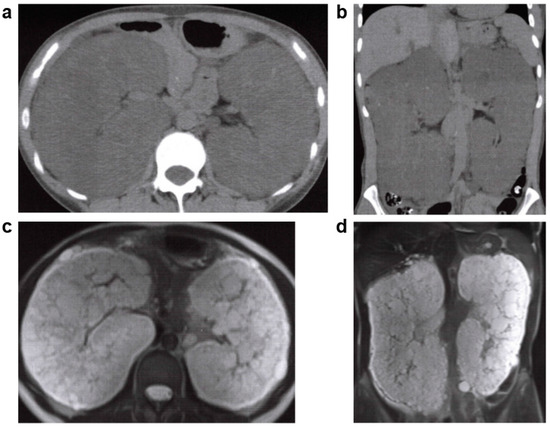 Cystic Kidney Diseases That Require a Differential Diagnosis from ...