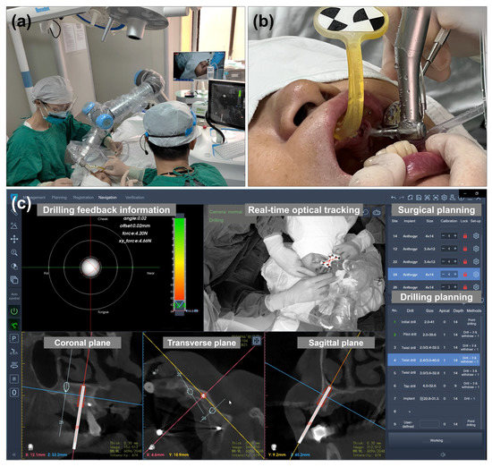 Autonomous Robotic Surgery for Immediately Loaded Implant-Supported ...