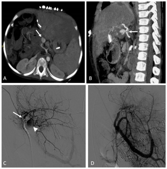 Embolization in Pediatric Patients: A Comprehensive Review of ...