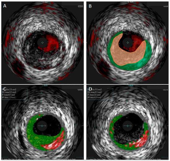 Intracoronary Imaging of Vulnerable Plaque—From Clinical Research to ...