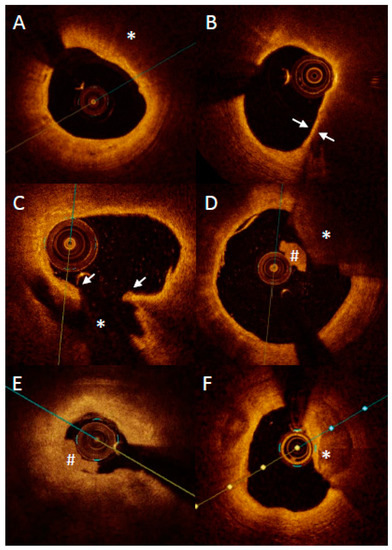 Intracoronary Imaging of Vulnerable Plaque—From Clinical Research to ...