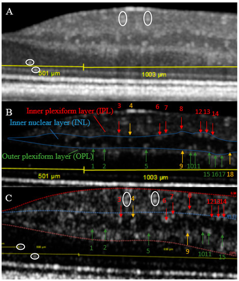Characterization of Hyperreflective Dots by Structural and Angiographic ...