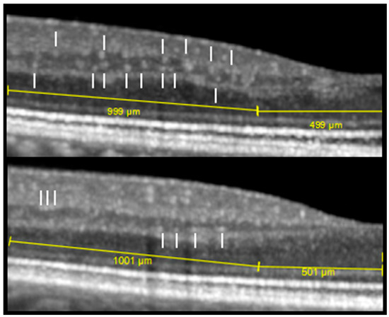 Characterization of Hyperreflective Dots by Structural and Angiographic ...