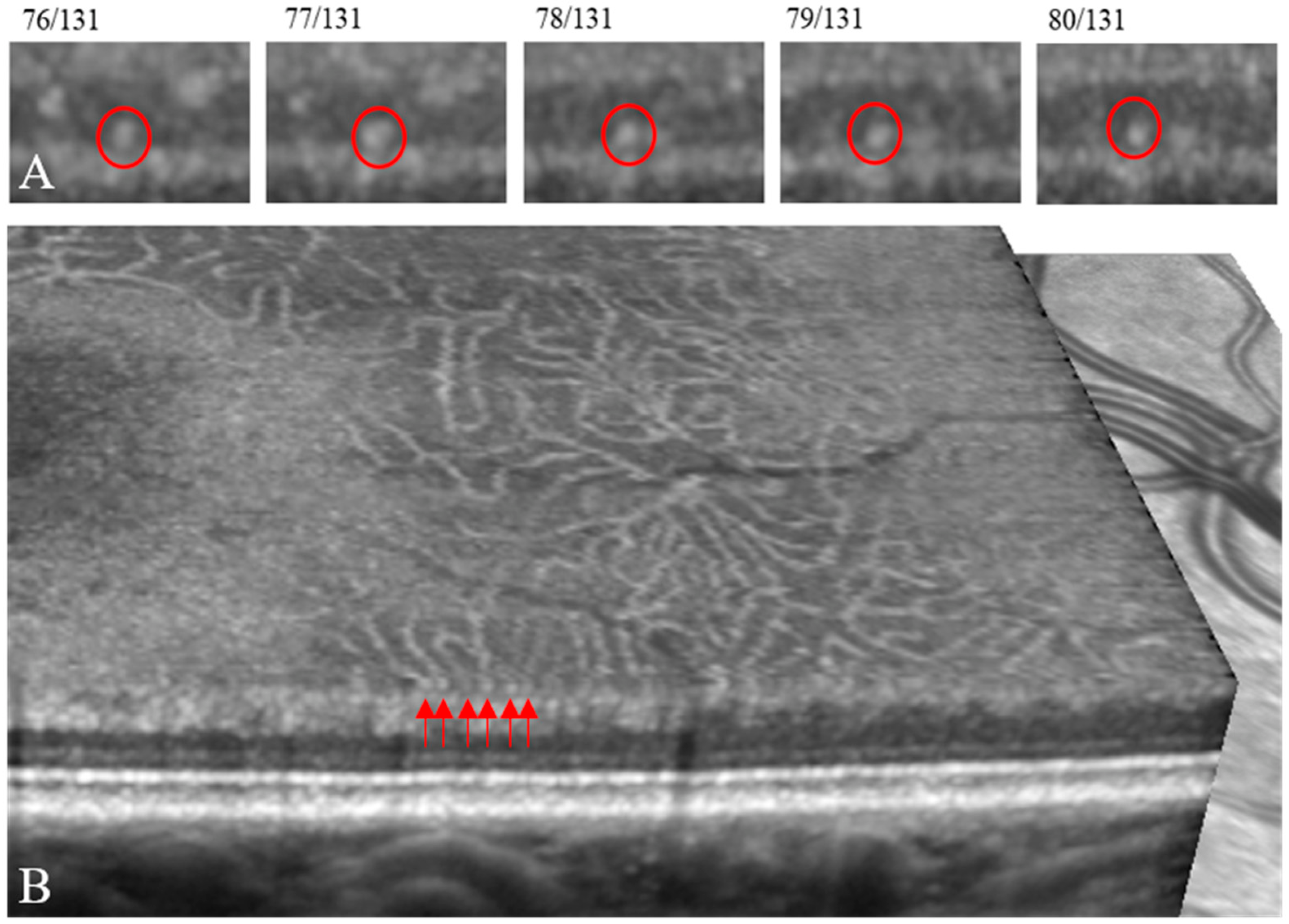 Characterization of Hyperreflective Dots by Structural and Angiographic ...