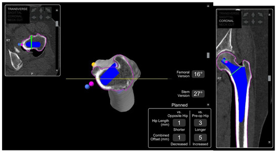 Robotics in Total Hip Arthroplasty: Current Concepts