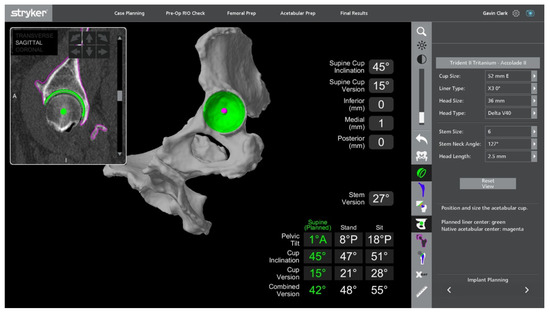 Robotics in Total Hip Arthroplasty: Current Concepts