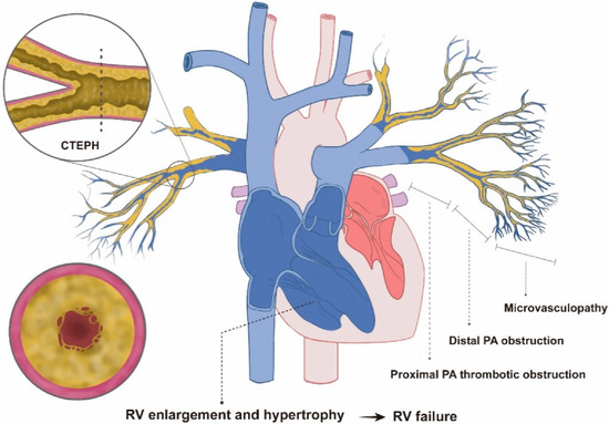 Clinical Presentations and Multimodal Imaging Diagnosis in Chronic Thromboembolic Pulmonary ...