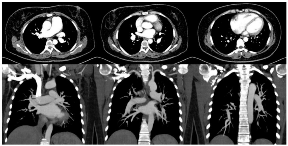 Clinical Presentations and Multimodal Imaging Diagnosis in Chronic ...