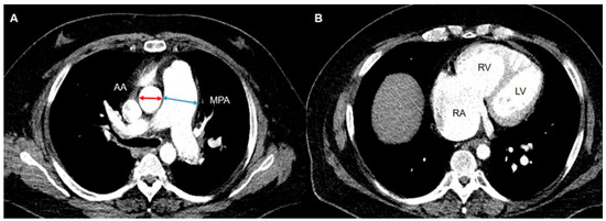 Clinical Presentations and Multimodal Imaging Diagnosis in Chronic ...