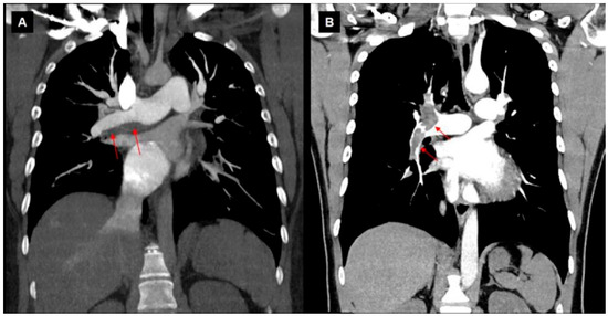 Clinical Presentations and Multimodal Imaging Diagnosis in Chronic ...