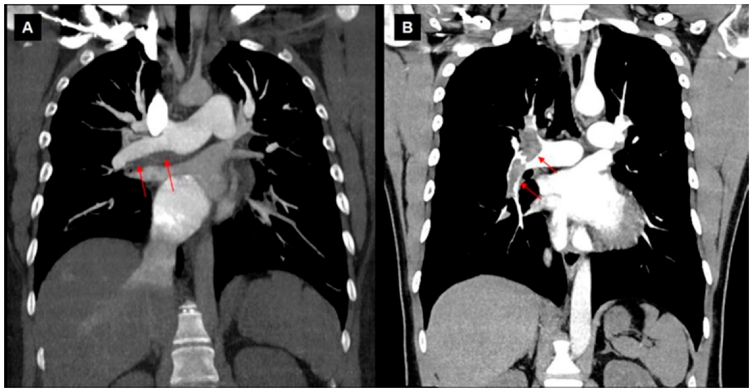 Clinical Presentations and Multimodal Imaging Diagnosis in Chronic ...
