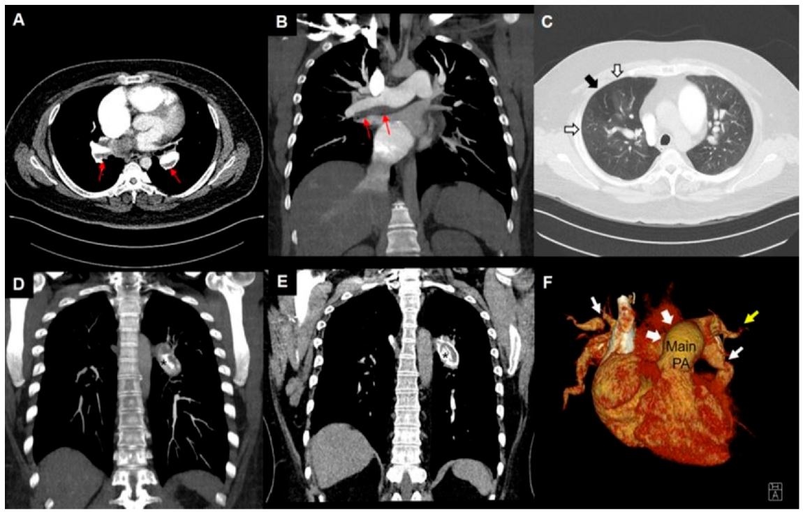 Clinical Presentations and Multimodal Imaging Diagnosis in Chronic ...