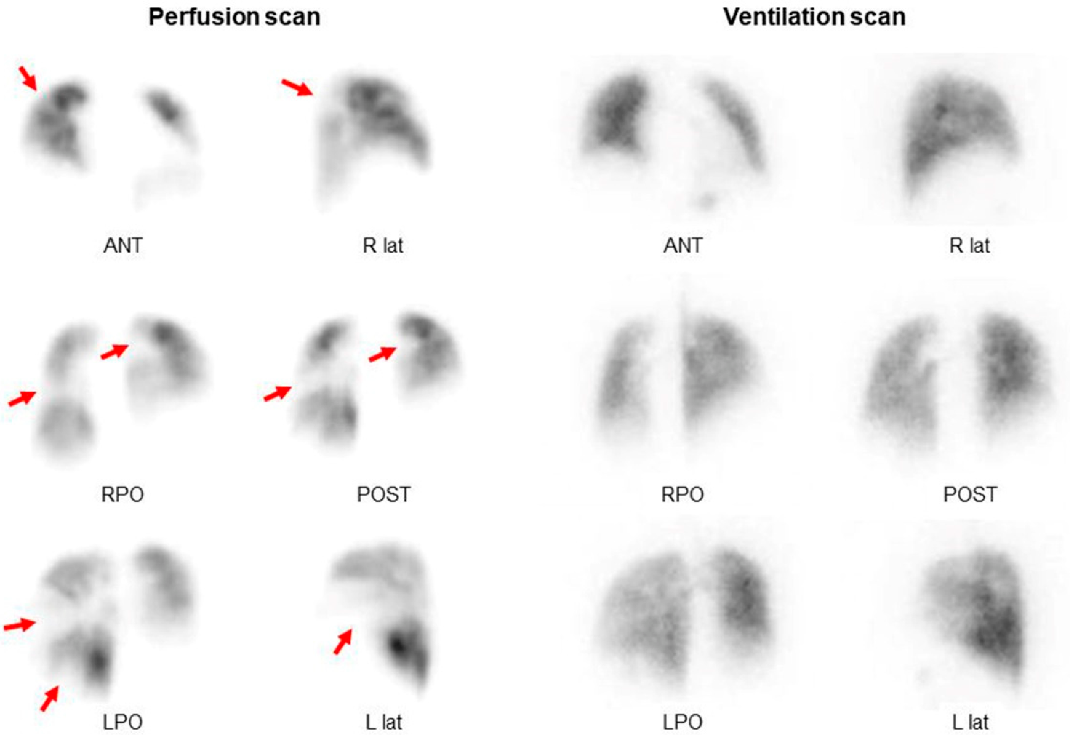 Clinical Presentations and Multimodal Imaging Diagnosis in Chronic ...