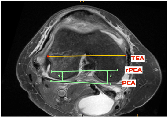 Femoral Component Rotation in Total Knee Arthroplasty Using a Tibia ...