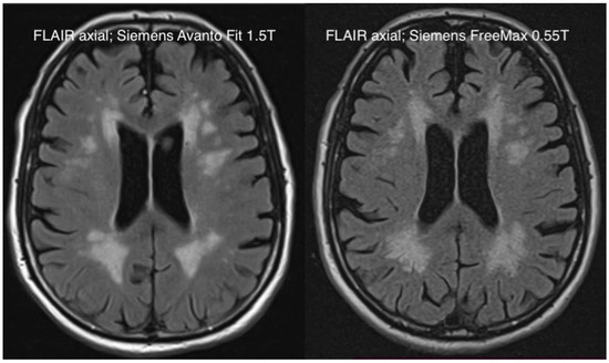 More Space, Less Noise—New-generation Low-Field Magnetic Resonance Imaging Systems Can Improve ...