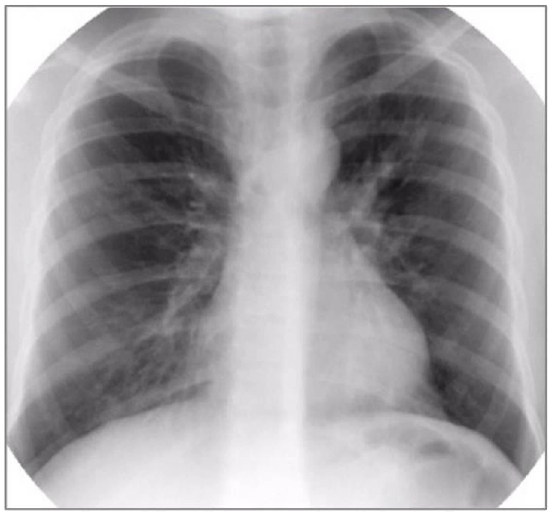 The Challenging Diagnosis of Interstitial Lung Disease in Children—One ...