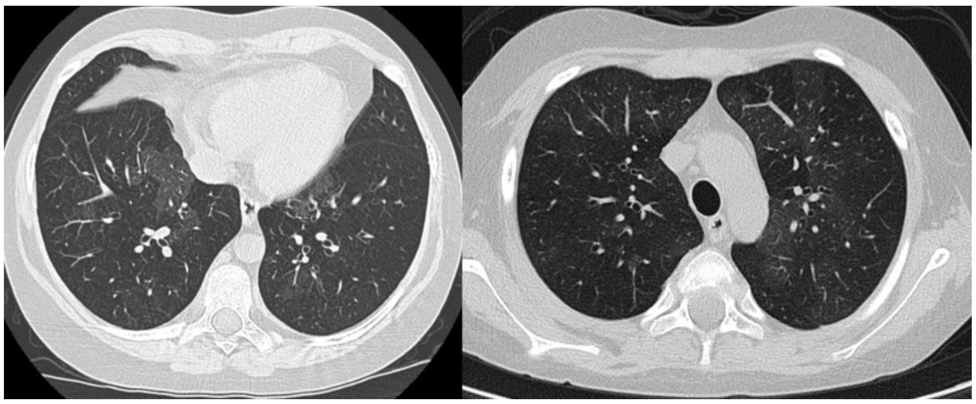 The Challenging Diagnosis of Interstitial Lung Disease in Children—One ...