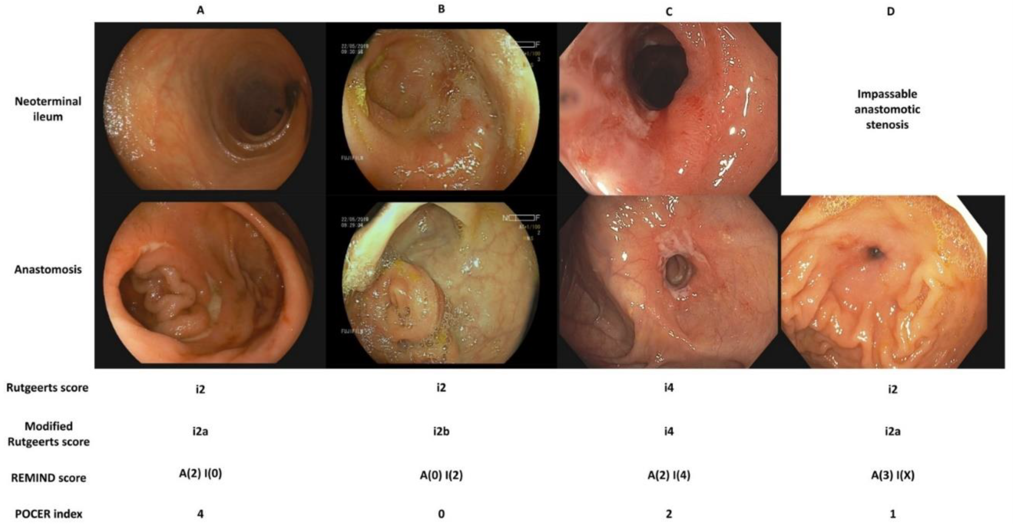 Aphthous Ulcers Crohns