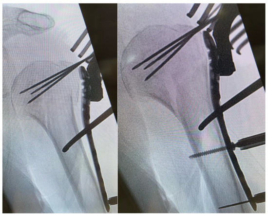 Feasibility and Radiological Outcome of Minimally Invasive Locked ...