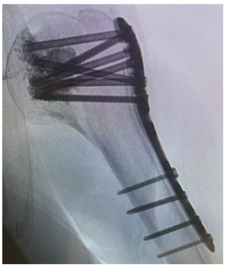 Feasibility and Radiological Outcome of Minimally Invasive Locked ...