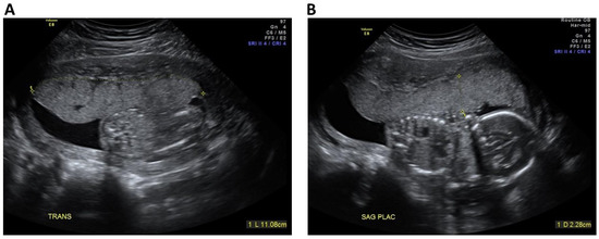 Contribution of Second Trimester Sonographic Placental Morphology to ...