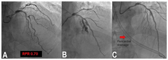Technical Complications of Coronary Bifurcation Percutaneous Interventions