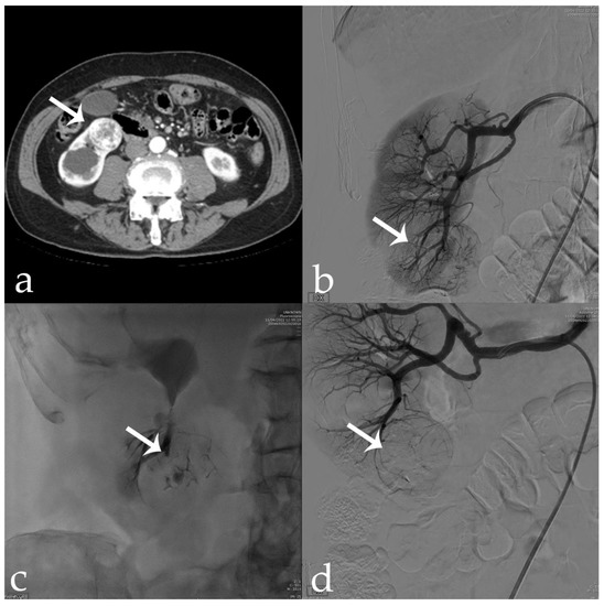 Green Tattoo Pre-Operative Renal Embolization for Robotic-Assisted and ...