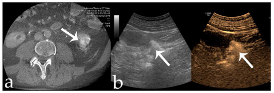 Green Tattoo Pre-Operative Renal Embolization for Robotic-Assisted and ...