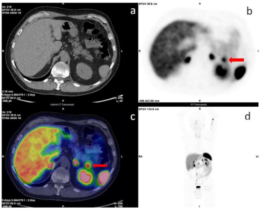Nuclear Medicine and Radiological Imaging of Pancreatic Neuroendocrine ...