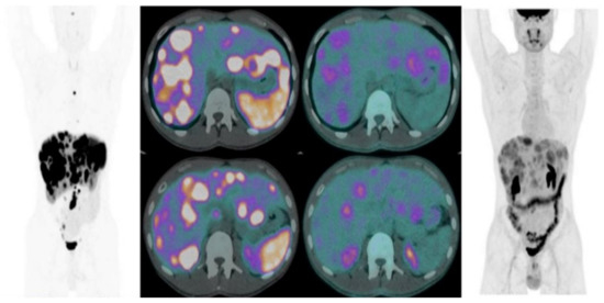 Nuclear Medicine and Radiological Imaging of Pancreatic Neuroendocrine Neoplasms: A ...